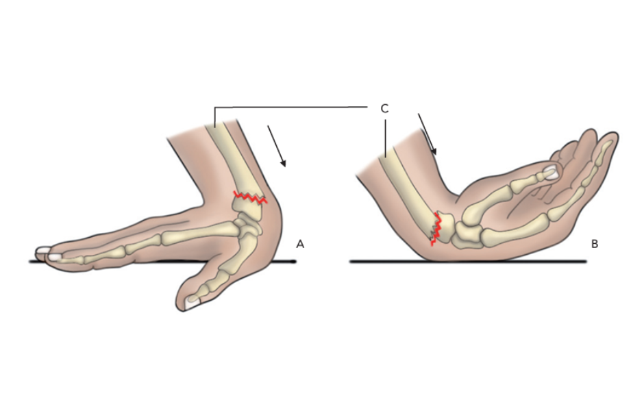 Pocket Traumachirurgie en orthopedie – Compendium Geneeskunde